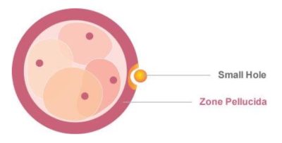 Laser Assisted Hatching (LAH) Technology